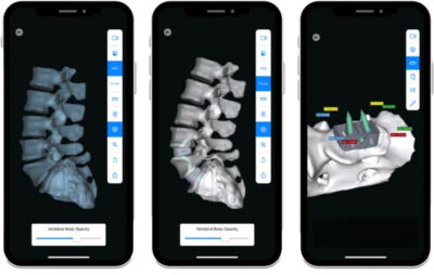 aprevo® Technology Platform - Carlsmed